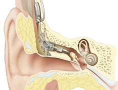 Woman receives UK's first implantable hearing aid